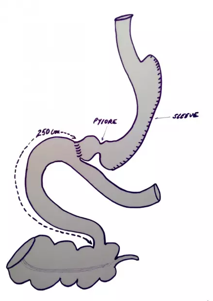 SADI, la nouvelle opération de chirurgie de l'obésité